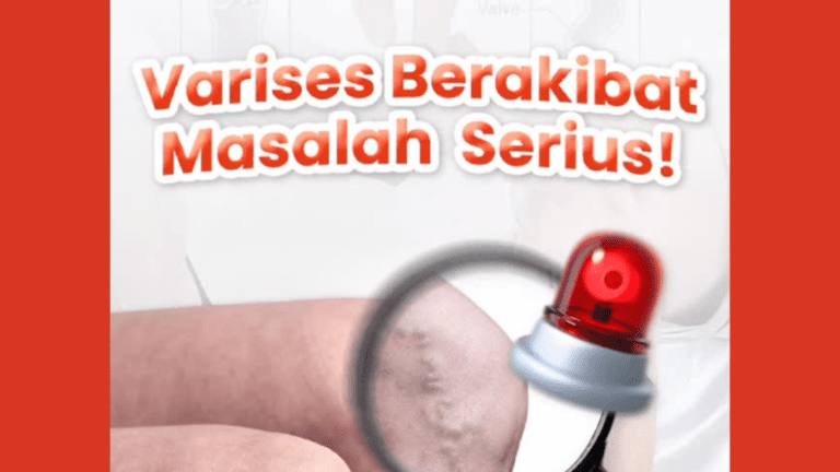 Varises Bukan Sekadar Masalah Estetika, Waspadai Risiko Seriusnya