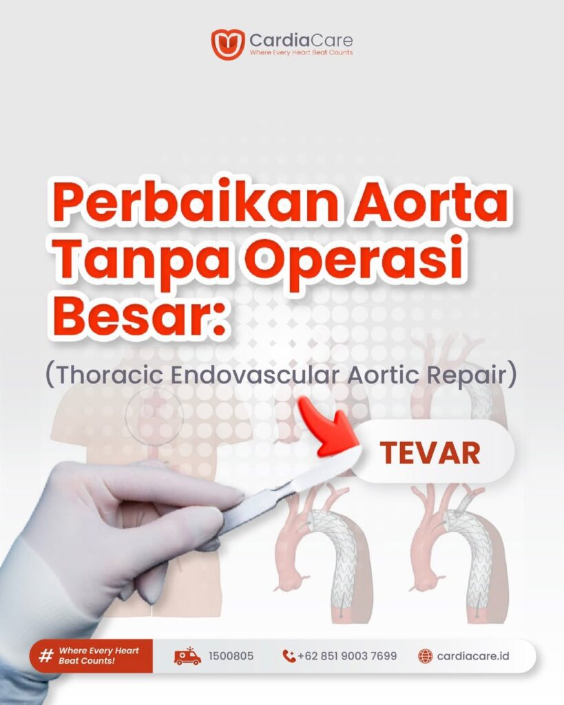 TEVAR: Perbaikan Aorta Tanpa Operasi Besar