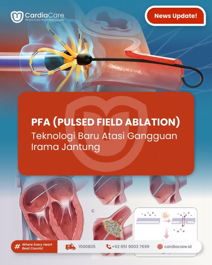 PFA (Pulsed Field Ablation): Teknologi Baru Atasi Gangguan Irama ...
